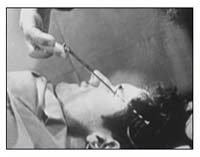 Lobotomy: Definition & Effects | Study.com